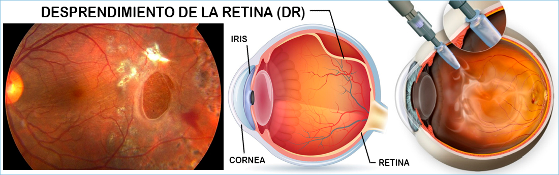 DESPRENDIMIENTO DE RETINA